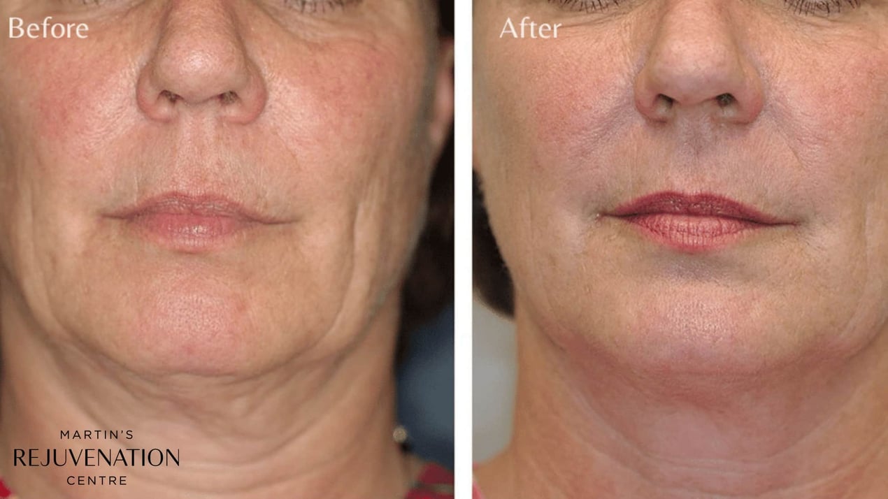 What You Should Expect Before and After Thermage: MRC Explains