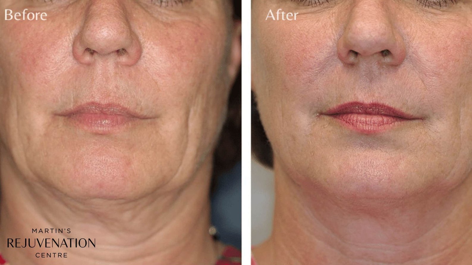 What You Should Expect Before and After Thermage: MRC Explains